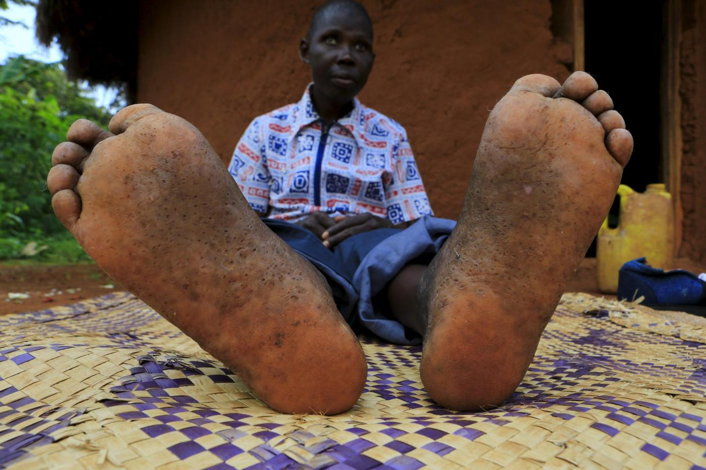 Uganda: scarpe gratis per tutti per combattere il parassita Jigger [FOTO]