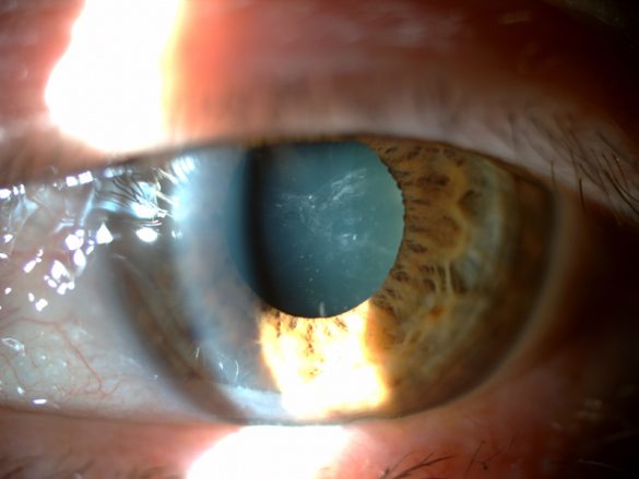 Cataratta: cause, sintomi, diagnosi, cura e prevenzione